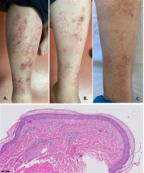Leptospirosis Rash