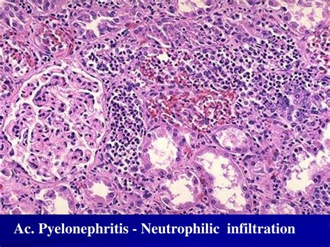 Ppt Pyelonephritis Powerpoint Presentation Free Download Id 9434452