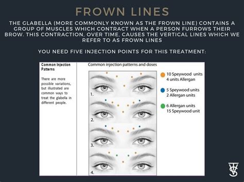Top 3 Botox Injection Patterns Markup Artofit