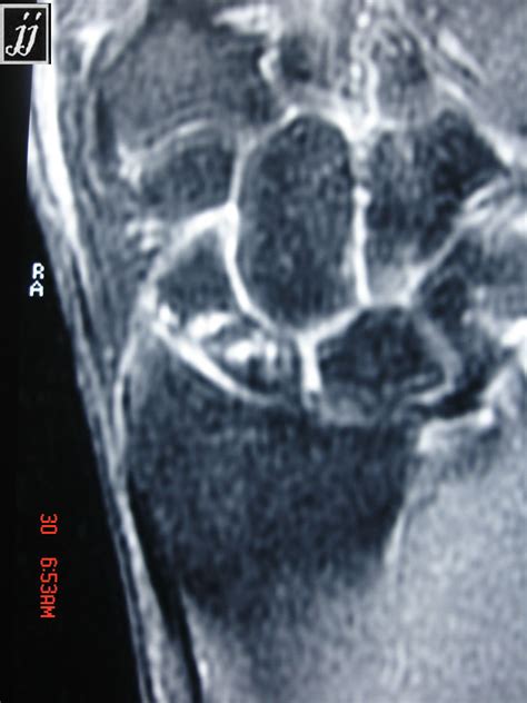 Msk Scaphoid Fracture And Avn Of Proximal Part And Ulnar Styloid Fracture 3 Radioogle