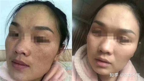 眼角黄褐斑能去掉吗？有什么方法？ 知乎