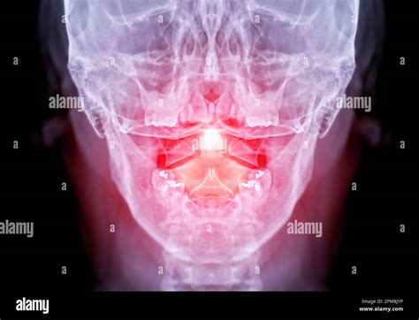 X Ray C Spine Or X Ray Image Of Cervical Spine Open Mount View For Fracture Of Cervical Vertebra