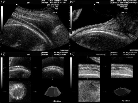 Uterine Lining Measurements