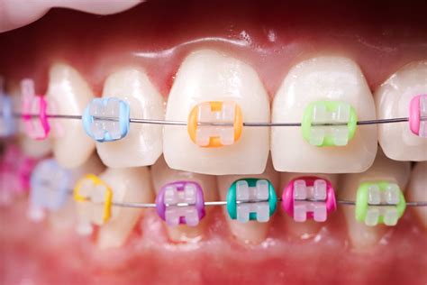 Rubber Bands With Braces What You Need To Know