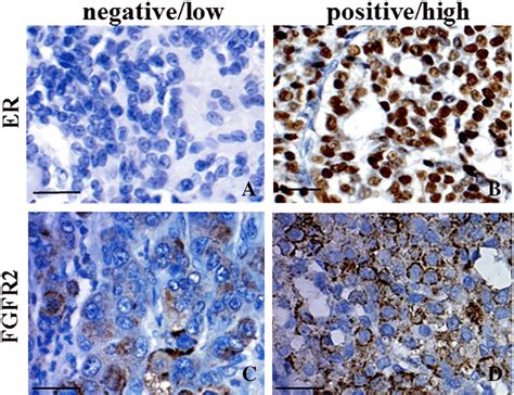Expression Of Er And Fgfr2 In Bca Tissue Samples Examples Of Low A