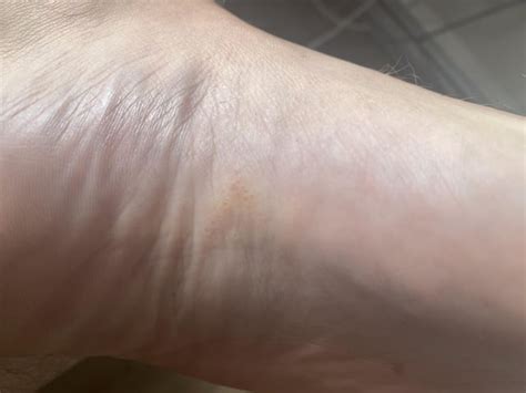 Scabies Or Another Mite R Dermatologyquestions