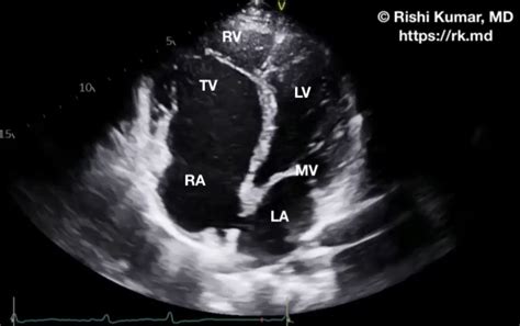 Ebstein Anomaly Echo Fetal Echocardiogram With Color Compares
