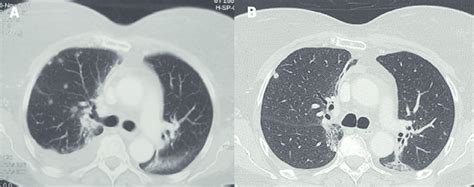 A Multiple Lung Metastasesmediastinal Nodal Diseasebilateral Pleural