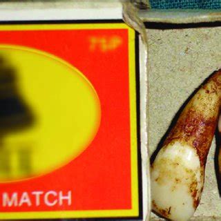 Modifi Ed Esthetic Splint In Position With The Acrylic Teeth Download Scientific Diagram