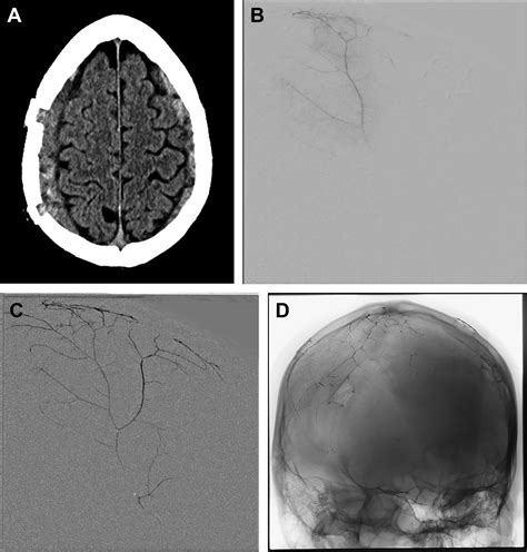Middle Meningeal Artery Embolization For The Management Of Chronic Subdural Hematoma Journal