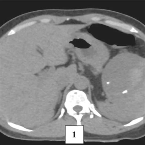 Plain Axial Ct Of The Cyst Showing Areas Of Relative Hyperdensity And Download Scientific