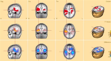 Besa® Brain Electrical Source Analysis Private Features Optimal Visualization