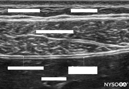 Exam Rectus Sheath Block Us Diagram Quizlet