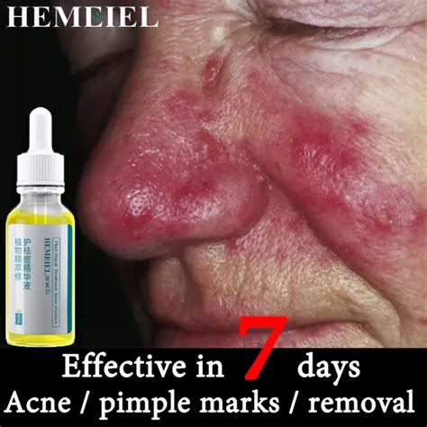 HEMEIEL Gamot Sa Tagyawat Sa Mukha Pimple Marks Remover Pimples Acne Remover Best Seller