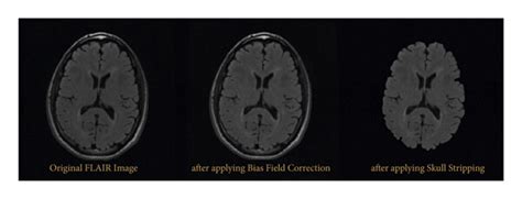 [retracted] Using Convolutional Neural Networks For Segmentation Of Multiple Sclerosis Lesions