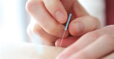 Dry Needling • Physiocité