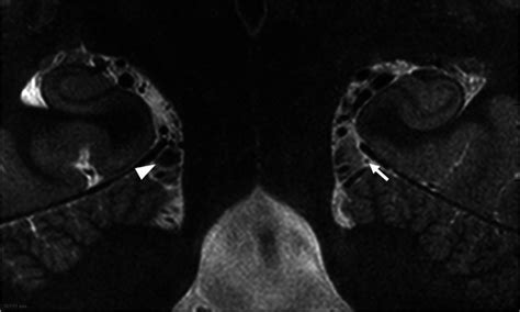 High Resolution 7t Mr Imaging Of The Trochlear Nerve Pmc