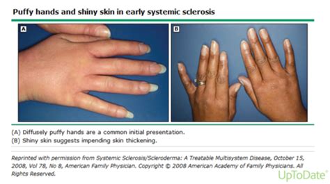 Systemic Sclerosis Scleroderma Sjogren And Dermyopathy Thing Flashcards Quizlet