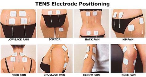 Tens Unit Sciatica Electrode Placement Artofit