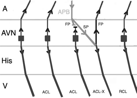 Response To An Atrial Premature Beat Delivered During His Download Scientific Diagram