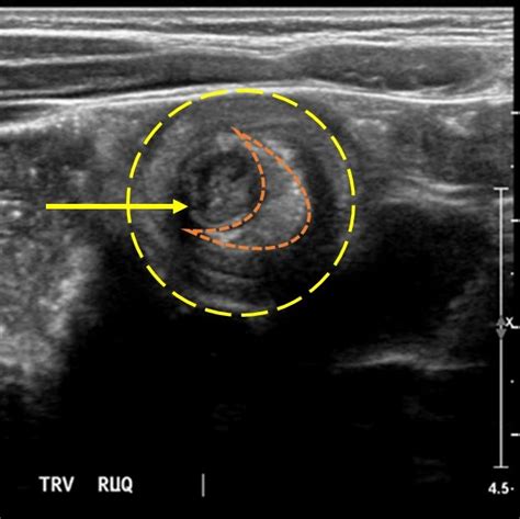 Brief Review Of Intussusception Diagnosis And Management Jetem