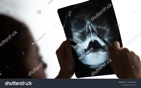 Sinus X Ray Images Stock Photos D Objects Vectors Shutterstock