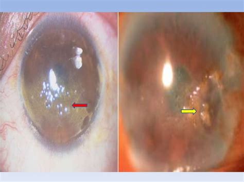 Corneal Degeneration Dystrophies Pptx