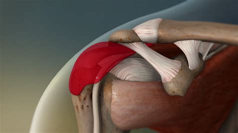 Bursitis Del Hombro Y Su Tratamiento Fisioterapéutico En Fisioclinics Palma Fisioclinics Palma