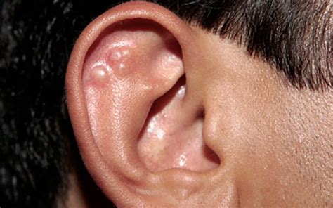 Rash Behind Ear Causes Symptoms And Treatments