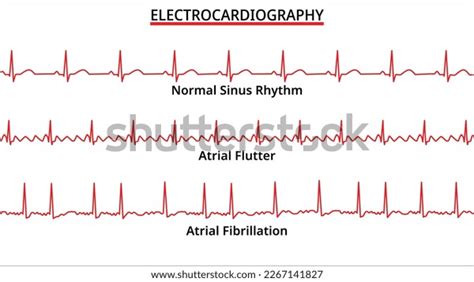 Set Ecg Common Abnormalities Atrial Flutter Stock Vector Royalty Free Shutterstock