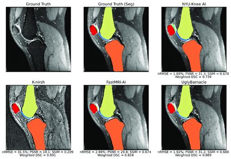 Sagittal Slice Segmentations Overlaid On Intermediate Pipeline