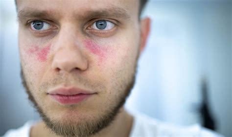 Lupus And Facial Flushing Telegraph