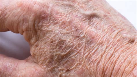 Heres Why You May Be Getting Sunspots On Your Hands