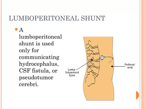 Hydrocephalus Ppt
