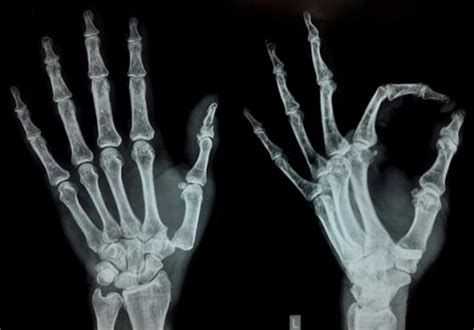 X Ray Showing Dislocation Of Thumb Carpometacarpal Joint Download Scientific Diagram
