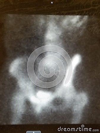 Pelvic Nuclear Medicine Bone Scan Normal Image Stock Photography CartoonDealer Com 258668420