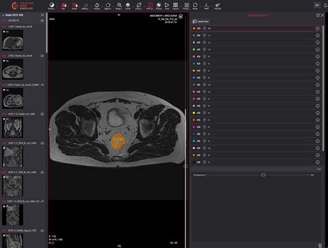 Dicom Rtstruct Essential Standard For Radiotherapy And Medical Image Segmentation