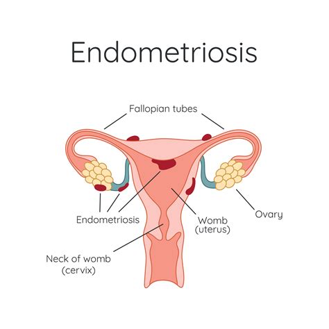 Endometriosis The Appearance Of The Disease Endometriosis Endometrium