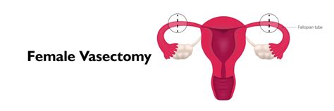 အမျိုးသမီး Vasectomy သို့မဟုတ် Tubal Ligation မှန်ကန်သောလမ်းကြောင်းကို ရွေးချယ်ပါ။
