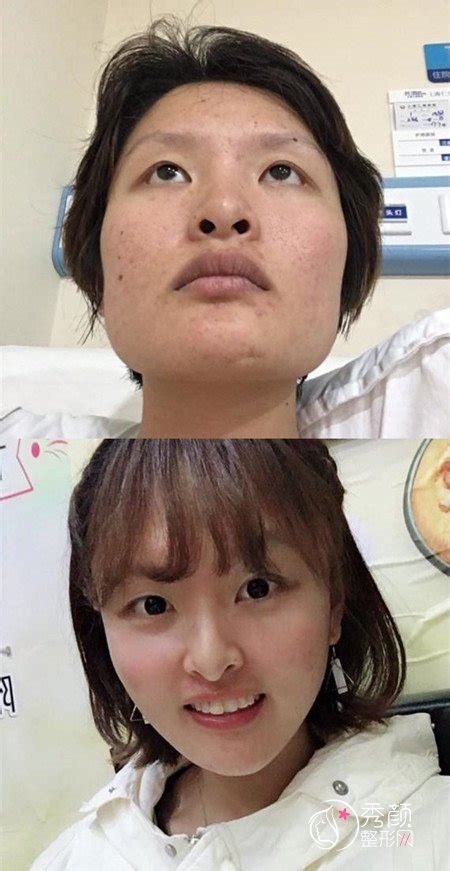 整形磨骨磨骨和削骨颧骨磨骨术大山谷图库