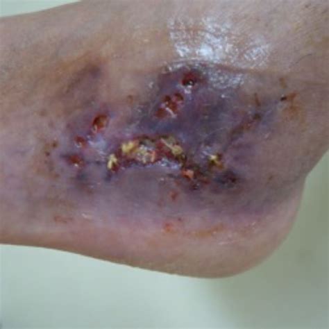 Early Pyoderma Gangrenosum