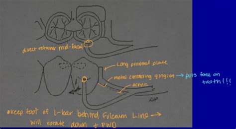 7 Distal Extension Rpd Design Flashcards Quizlet