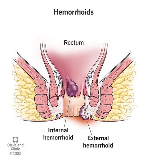 What Are Hemorrhoids Causes Symptoms Treatments And More Chiid Health