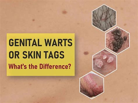 Female Genital Warts Symptoms Of Hpv Genital Warts Medizzy