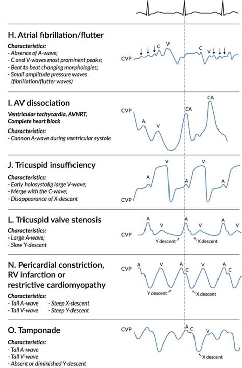 Central Venous Pressure Cvp Trauma Icu