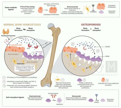 Management Of Osteoporosis My Endo Consult