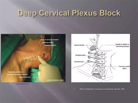 25820 Cervical Plexus Block 1 Pptx