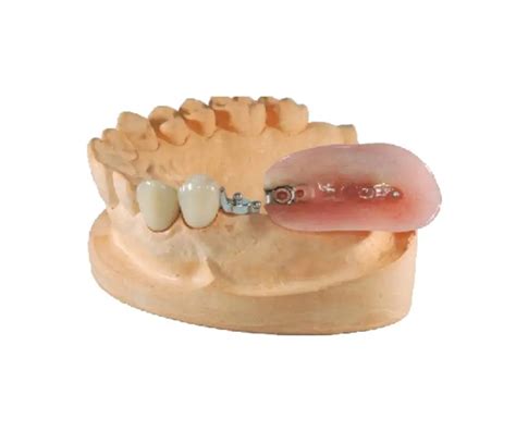 What Is Precision Attachment In Denture At Mary Greenwell Blog