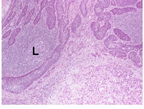 Conventional Nodal Metastasis Of Oral Scc Showing Basaloid Upper Half Download Scientific