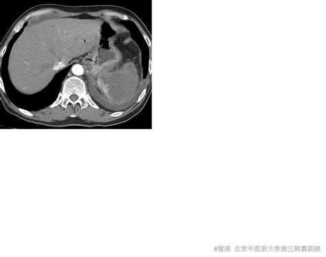 肝肾巨大囊性占位
